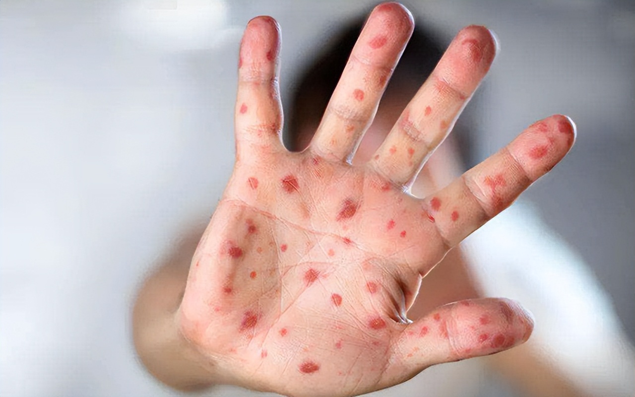 Does allergic purpura recur sporadically? - iNEWS