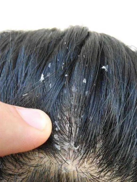 What should I do if I have severe dandruff? - iNEWS