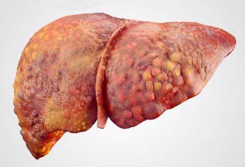 The natural "Rotten Liver King" was found out, the doctor: I don't want ...