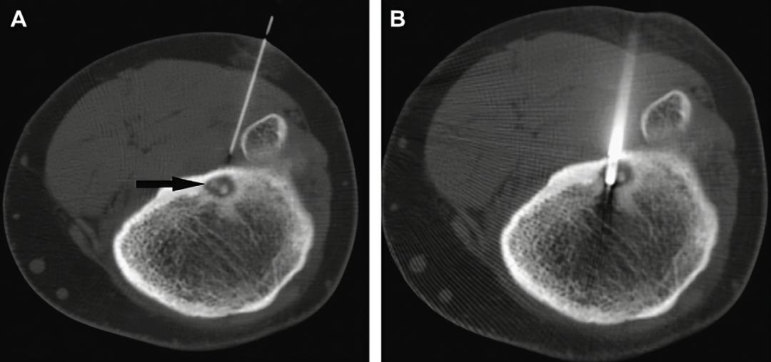 What is an ablation study? - iMedia