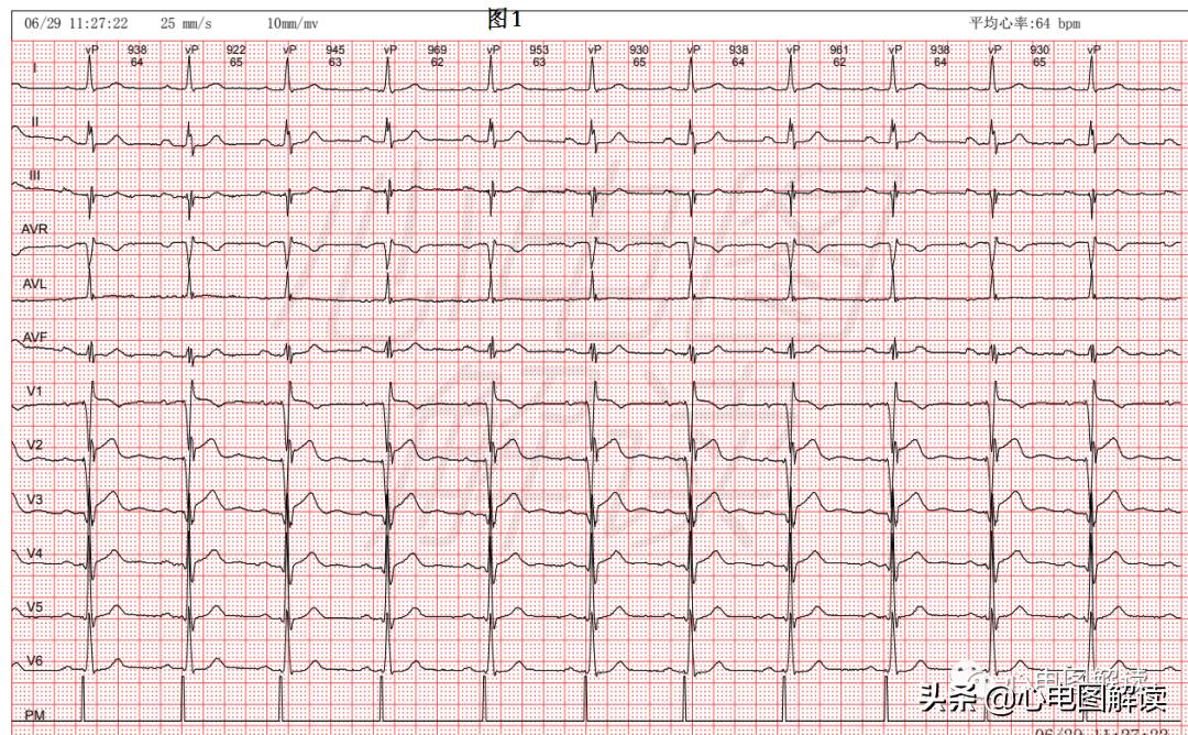 The 2 most common working modes of dual-chamber pacemakers and their ...