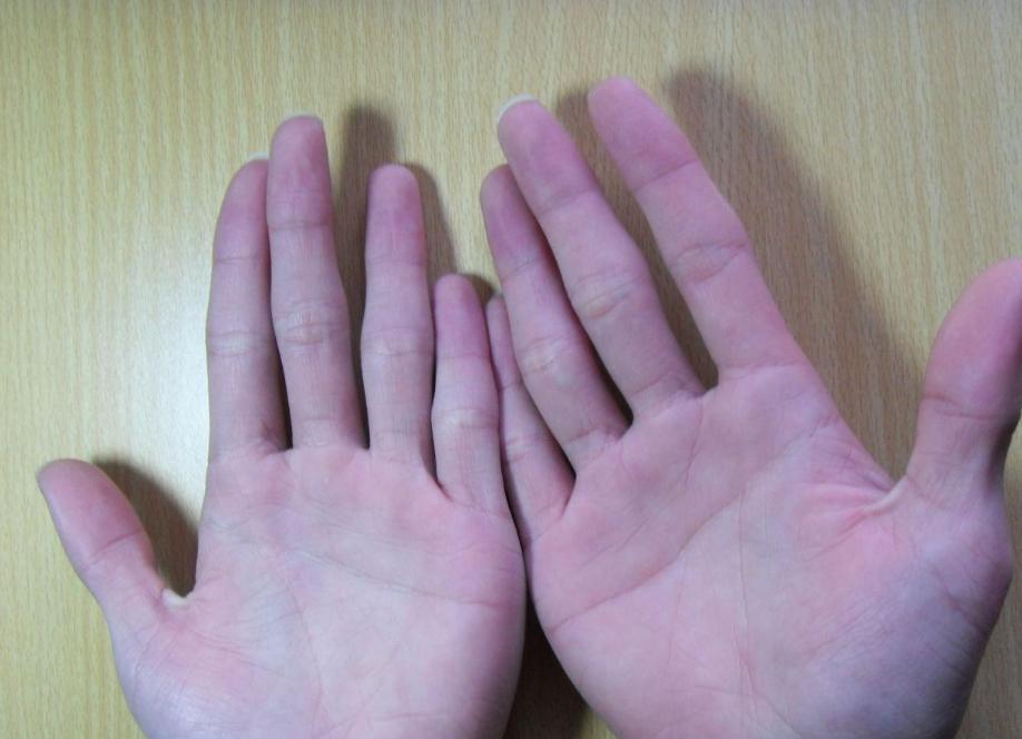 As the saying goes: "A broken palm is a line, wealth and honor are not ...