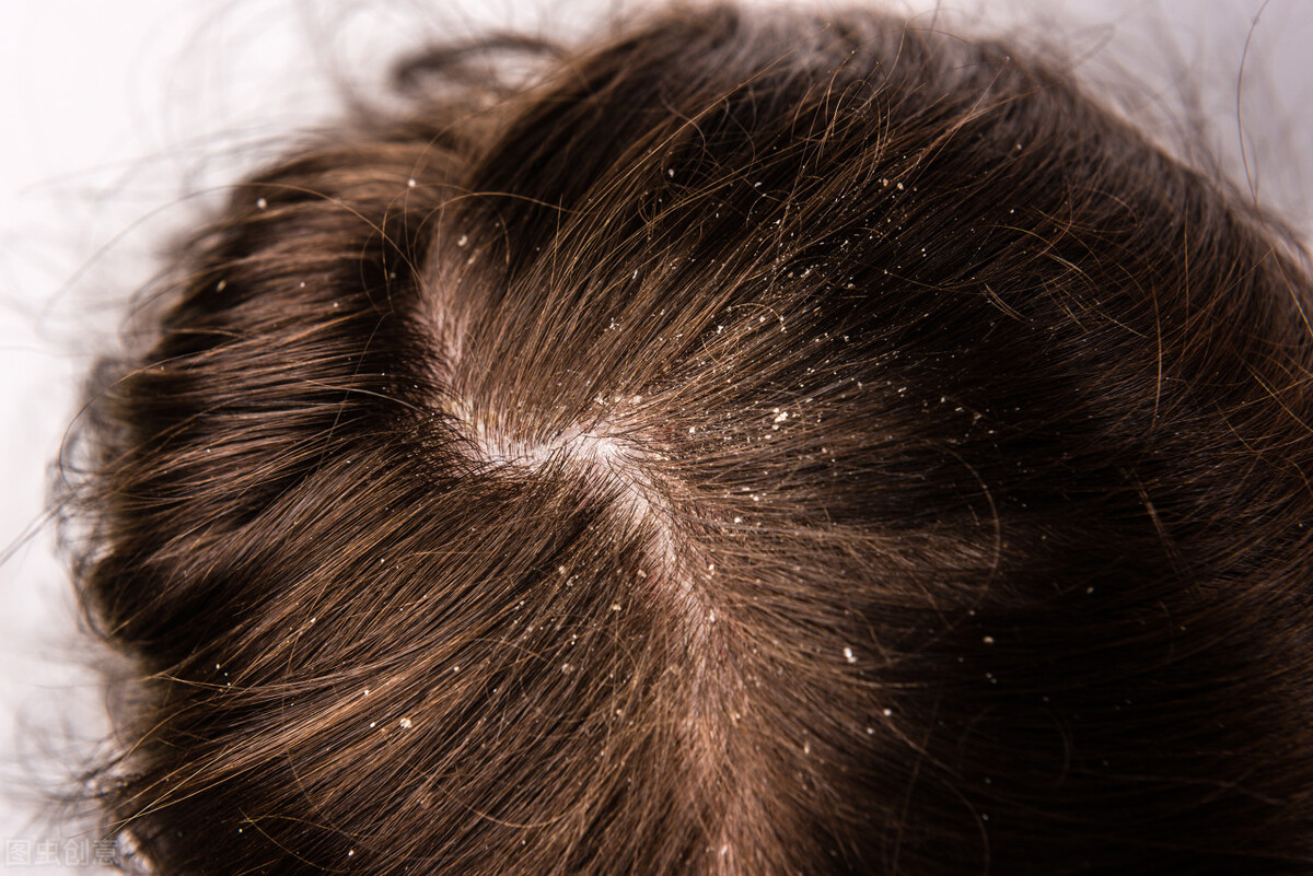 The dandruff is like snowflakes and the scalp is very greasy, don't ...