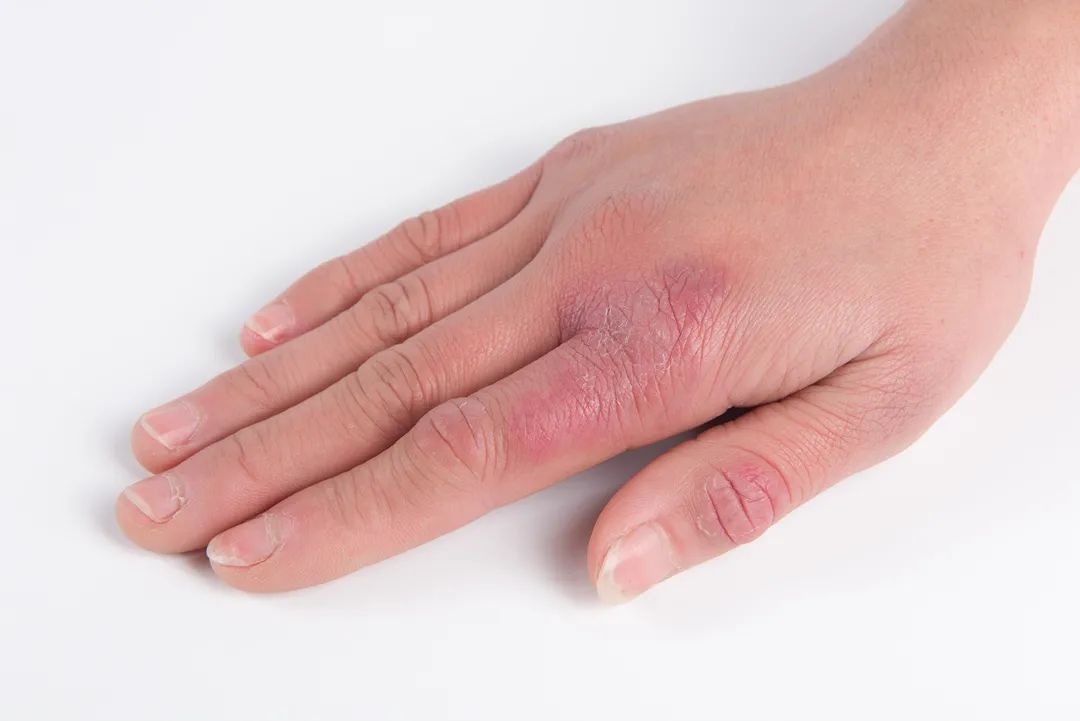 Dryness, itching, cracking, frostbite, these skin problems will teach ...