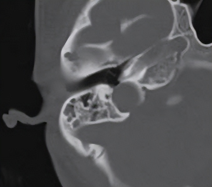 Perforated tympanic membrane, ear pus, hearing loss, can it be cured ...