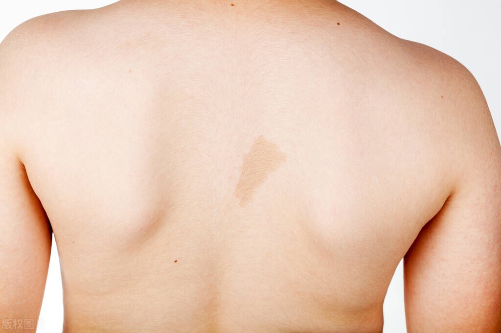 Birthmark science: the probability of canceration of congenital ...