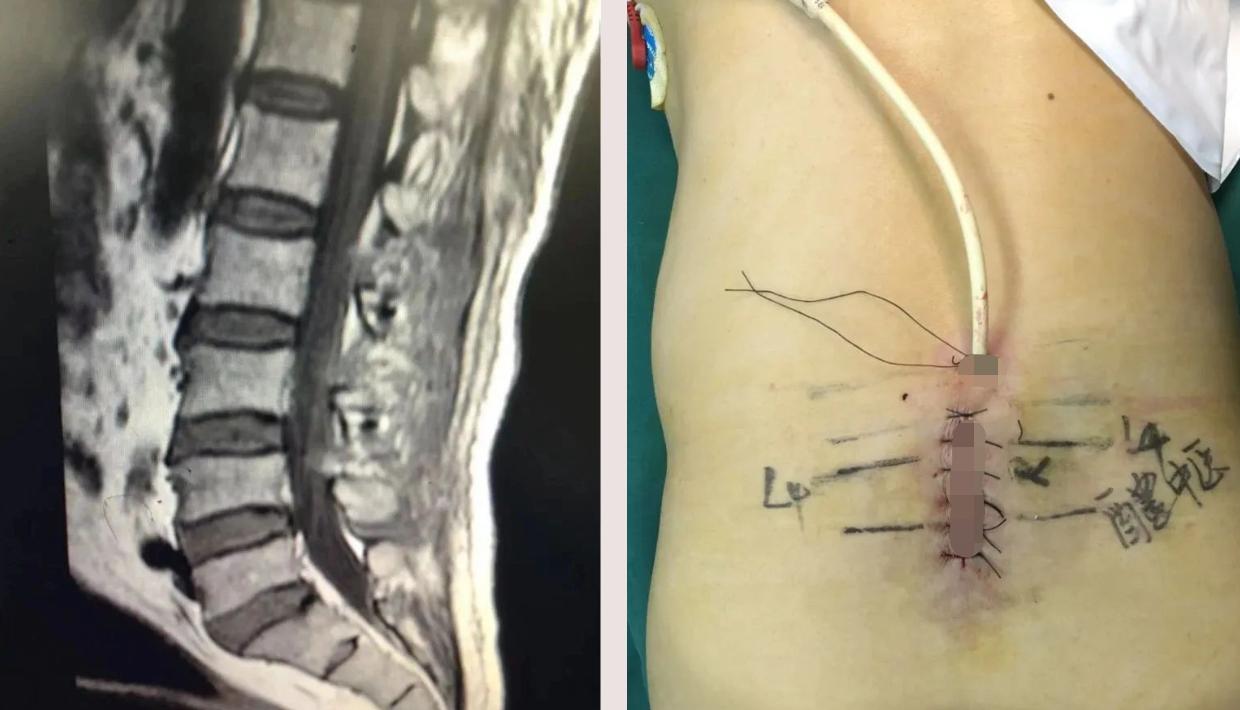A man suffered from waist and leg pain for 4 months. He thought it was ...