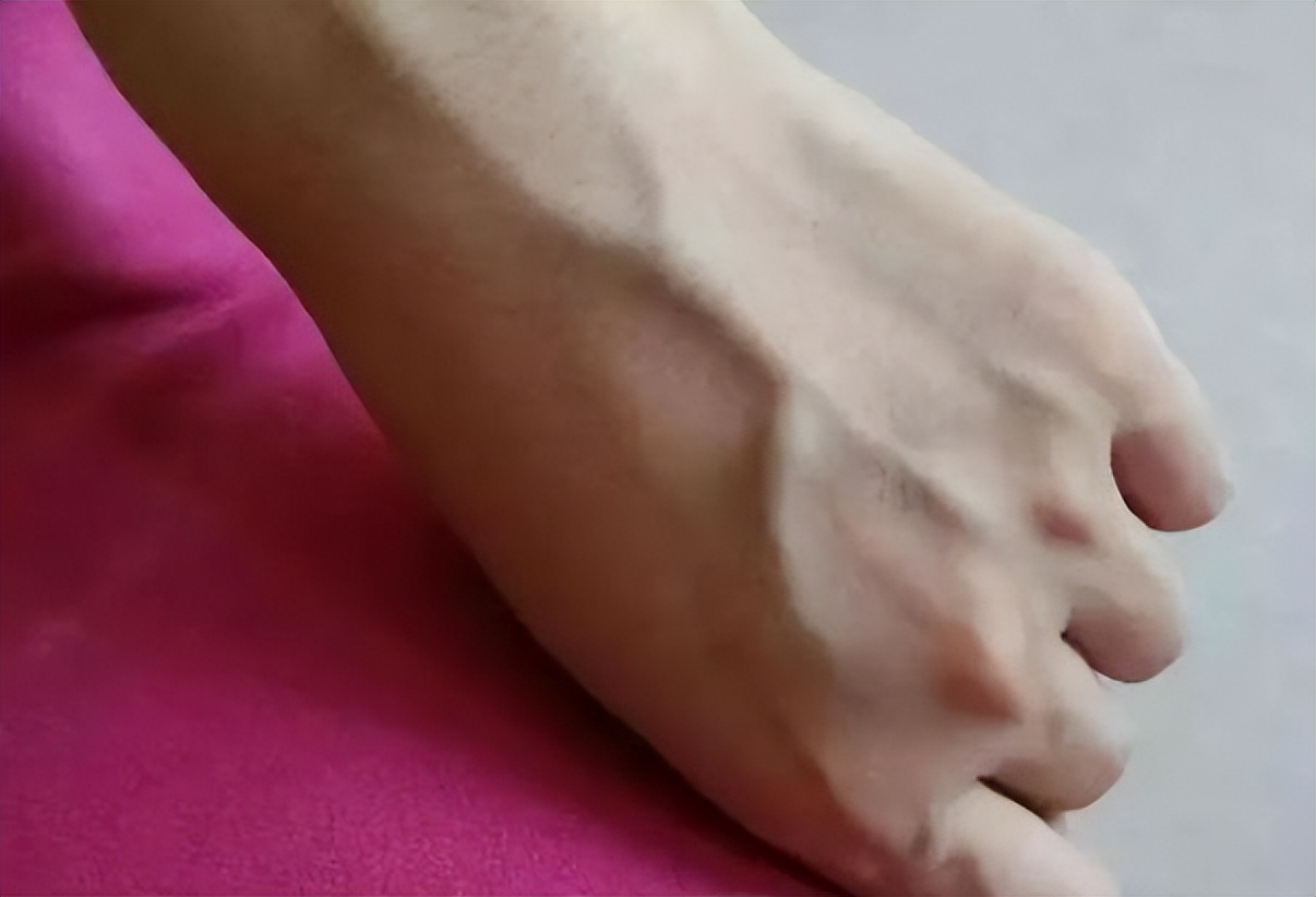 Why some people have "blue veins bursting out" on their arms, but some ...
