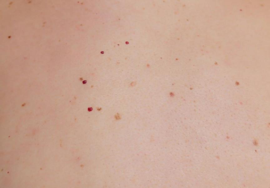 Small red moles on the body mean there is a problem with the liver? The ...