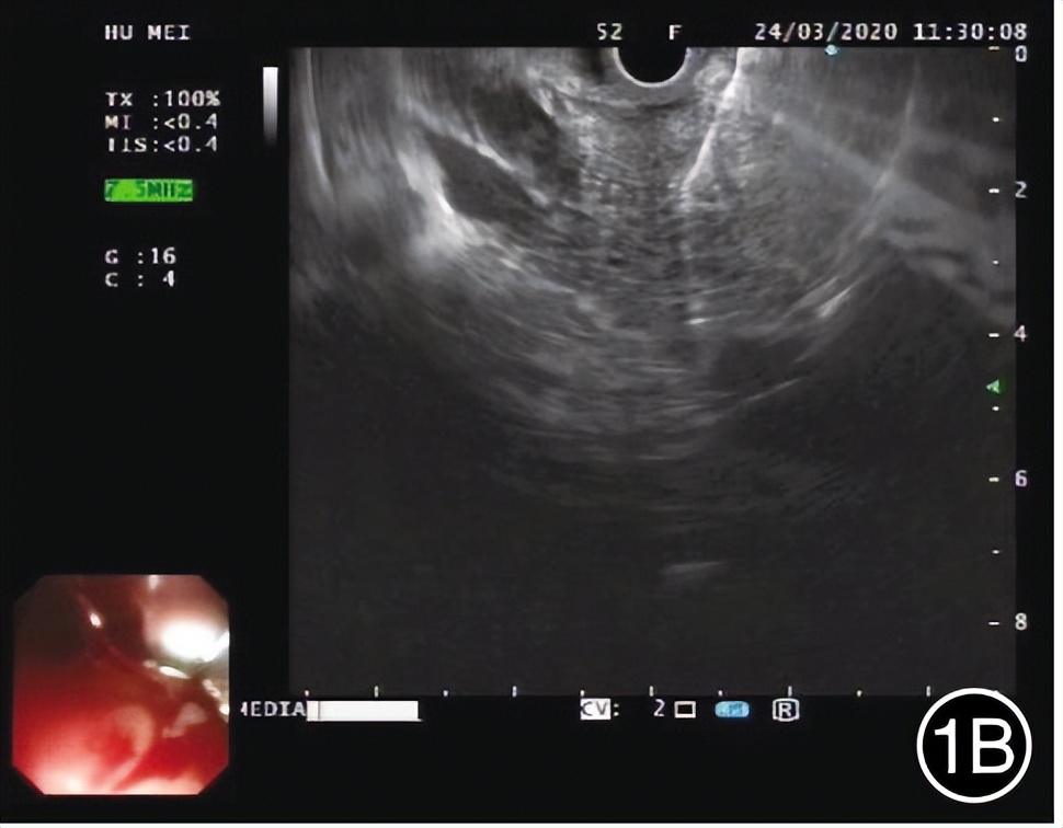 Diagnostic value of endoscopic ultrasound-guided fine needle aspiration for pancreas combined ...