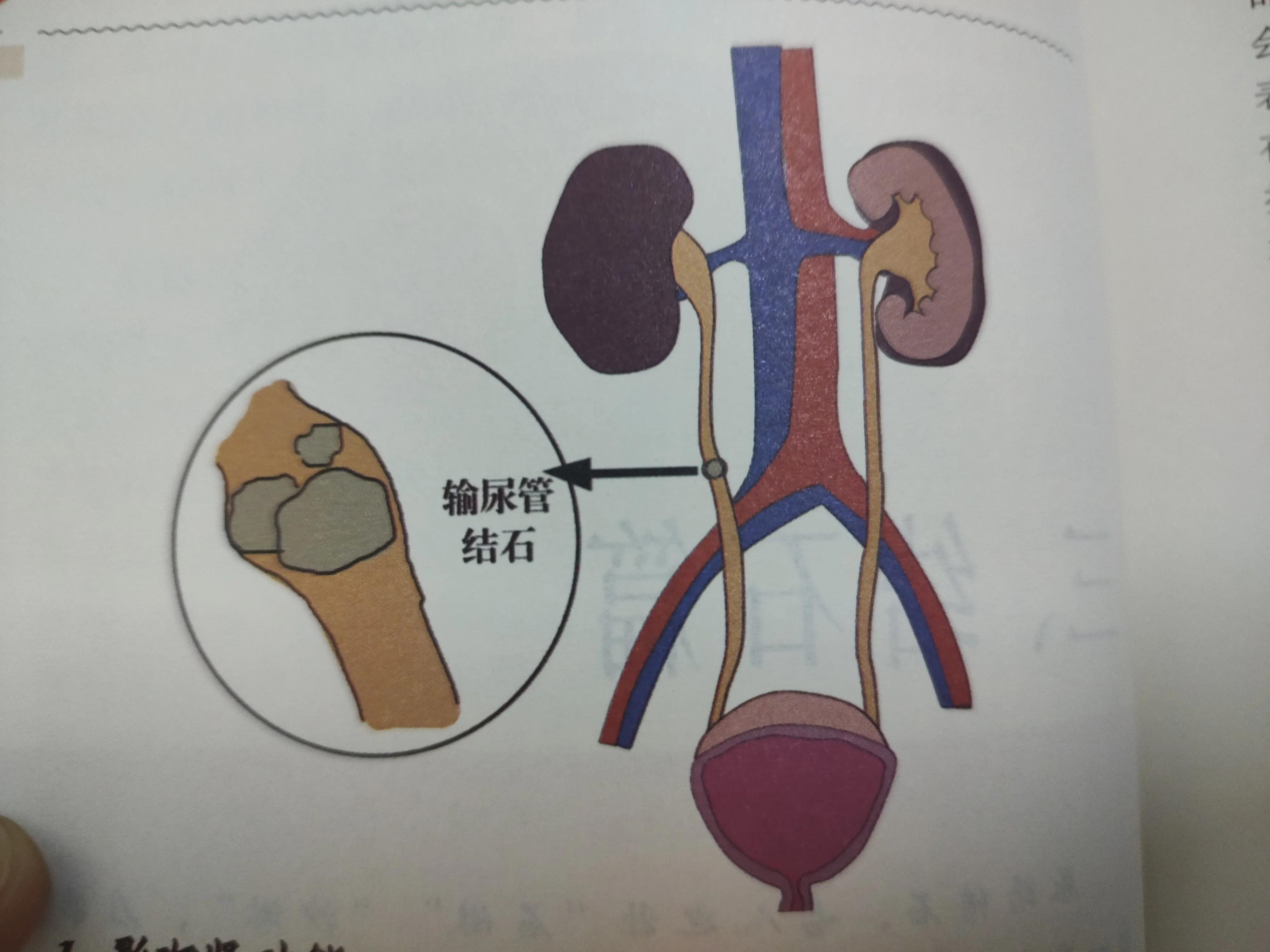 How much do you know about ureteral calculi? - iNEWS