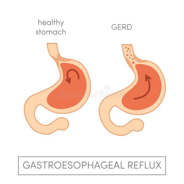 Gastroesophageal reflux and dietary conditioning from the perspective ...