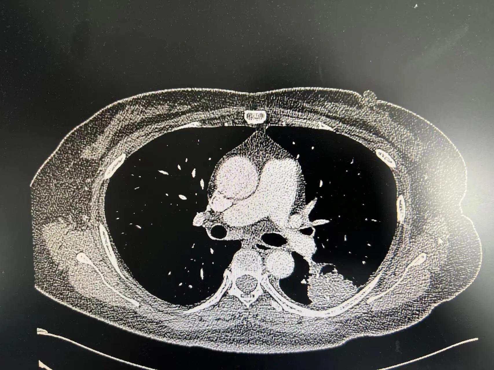 Causes and countermeasures of cough after lung surgery (advantages of ...