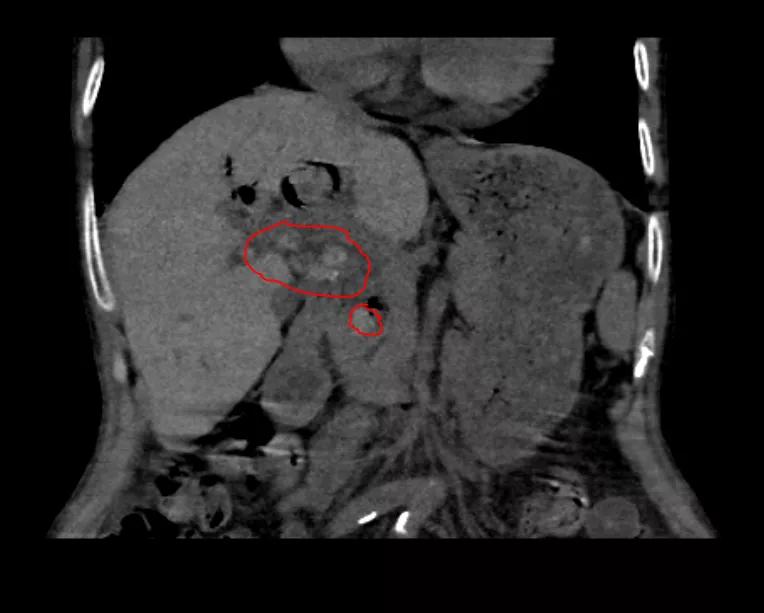 Single-port laparoscopic surgery, making minimally invasive more ...