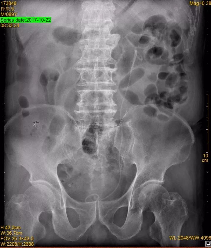"Diagnosis and Treatment Dynamics" 89-year-old kidney stone man set a ...