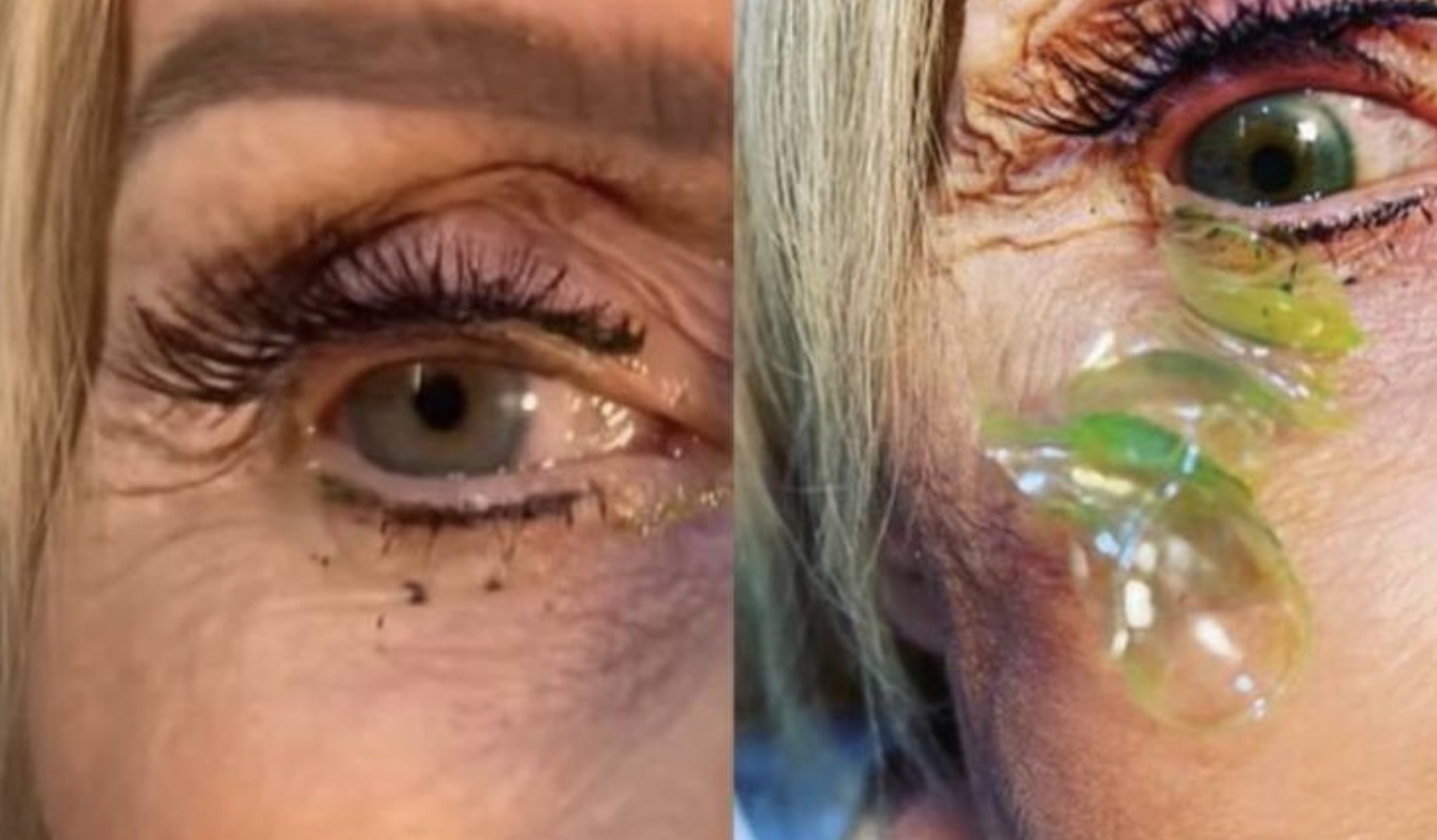 The woman's eyes were uncomfortable, the doctor took out 23 contact ...