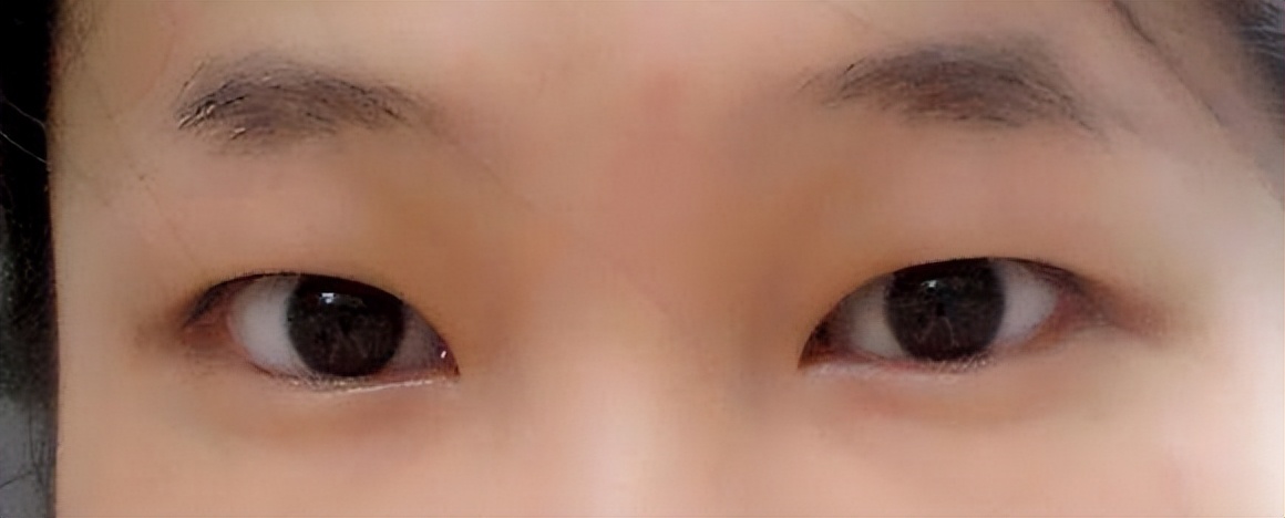 If you want to improve swollen eye blisters, it is best to choose a ...