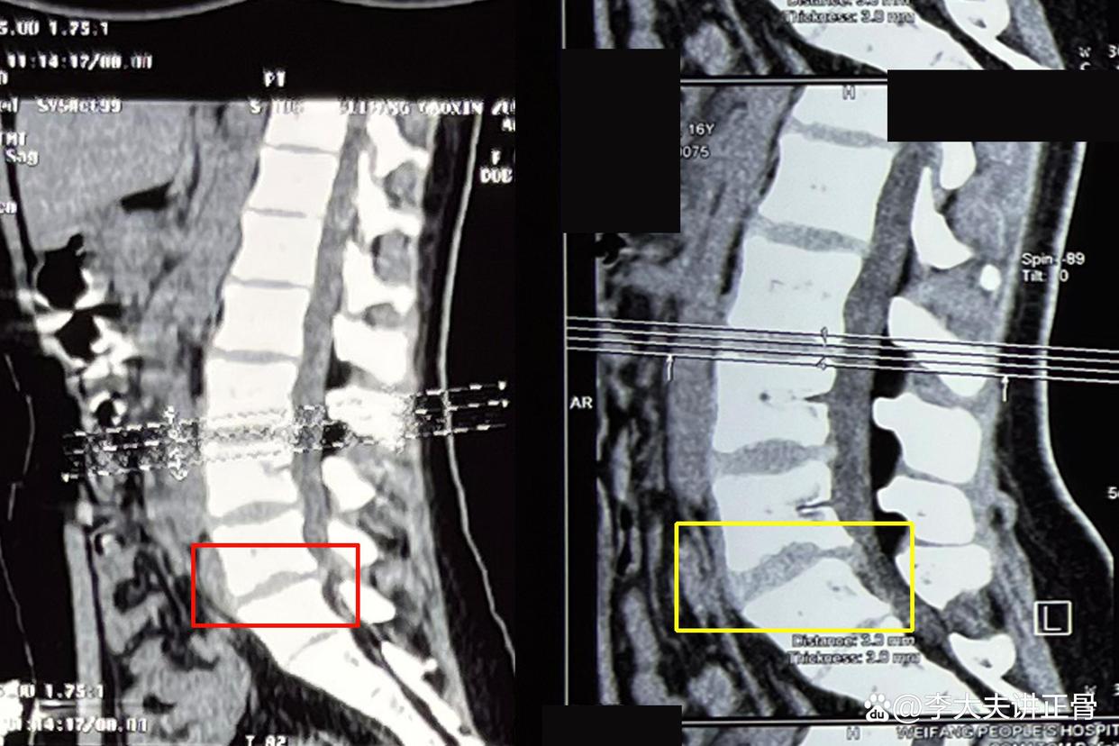 "Case Sharing" Heart-wrenching 16-year-old girl with lumbar ...