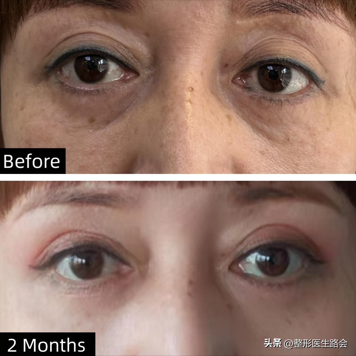 40-50 years old have deep tear grooves, what should I do? The doctor ...