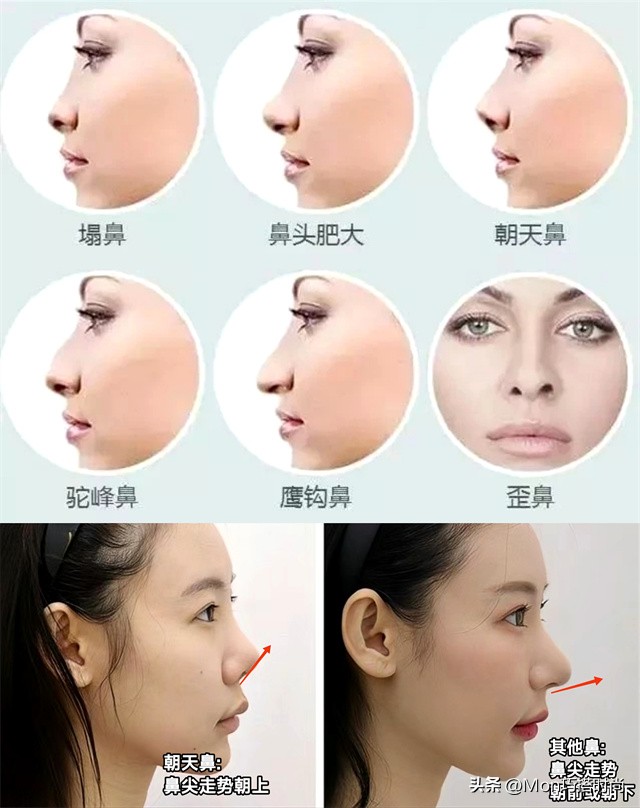 What is a flat nose? It is only when the "nostrils are exposed" that it ...