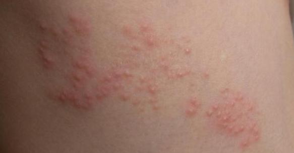 The "three rashes" that are common in summer, each one is "difficult ...