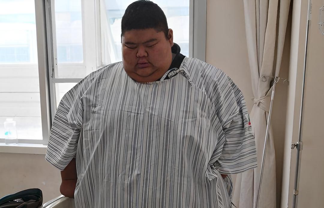 A 666-pound boy has one third of his stomach cut for weight loss!I lost ...
