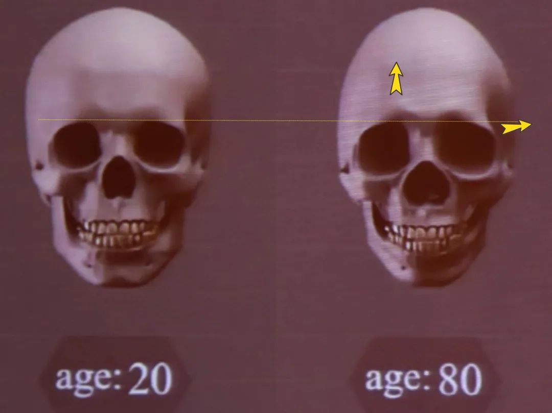 Bone aging affects appearance - iNEWS