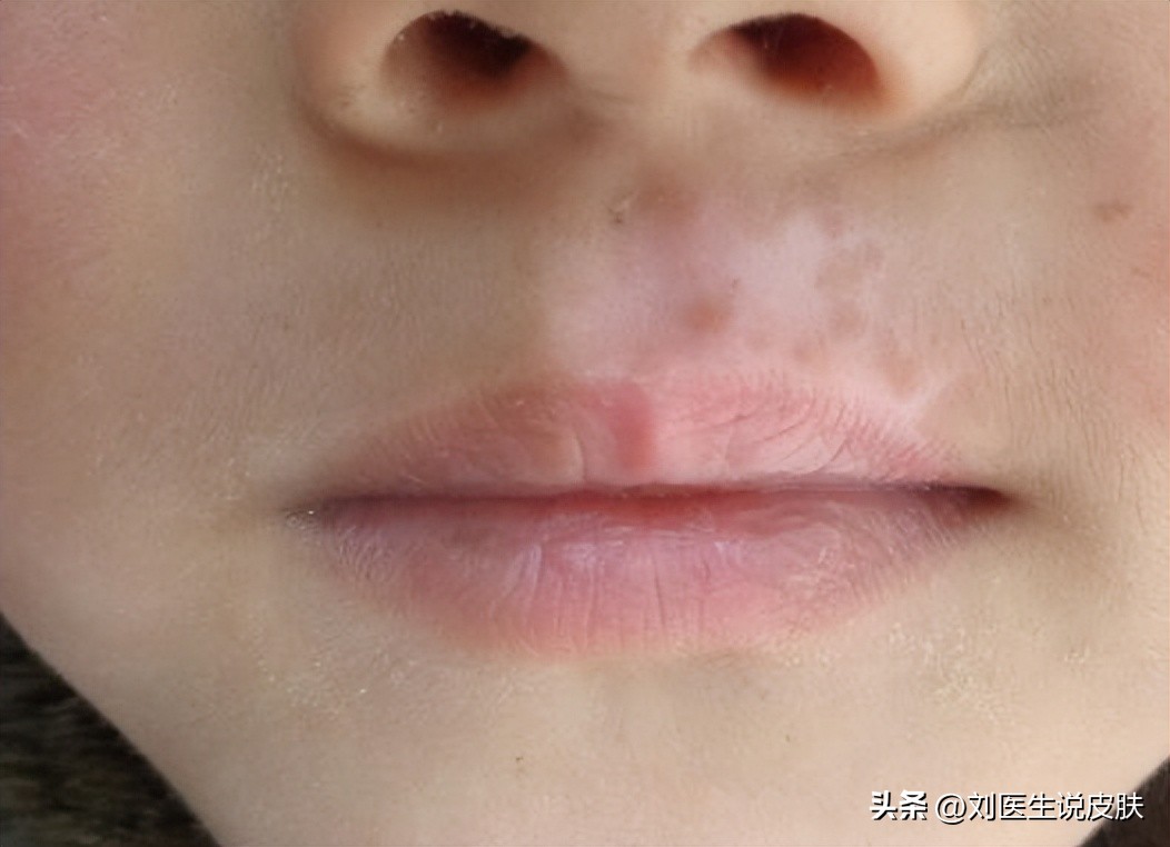 White spots on the skin in summer are not all vitiligo, but these 3 ...