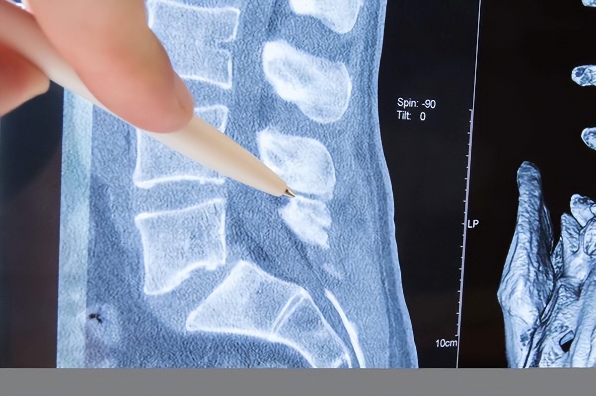 Li Yuchun's Ankylosing Spondylitis: Most of the people "entangled" by ...