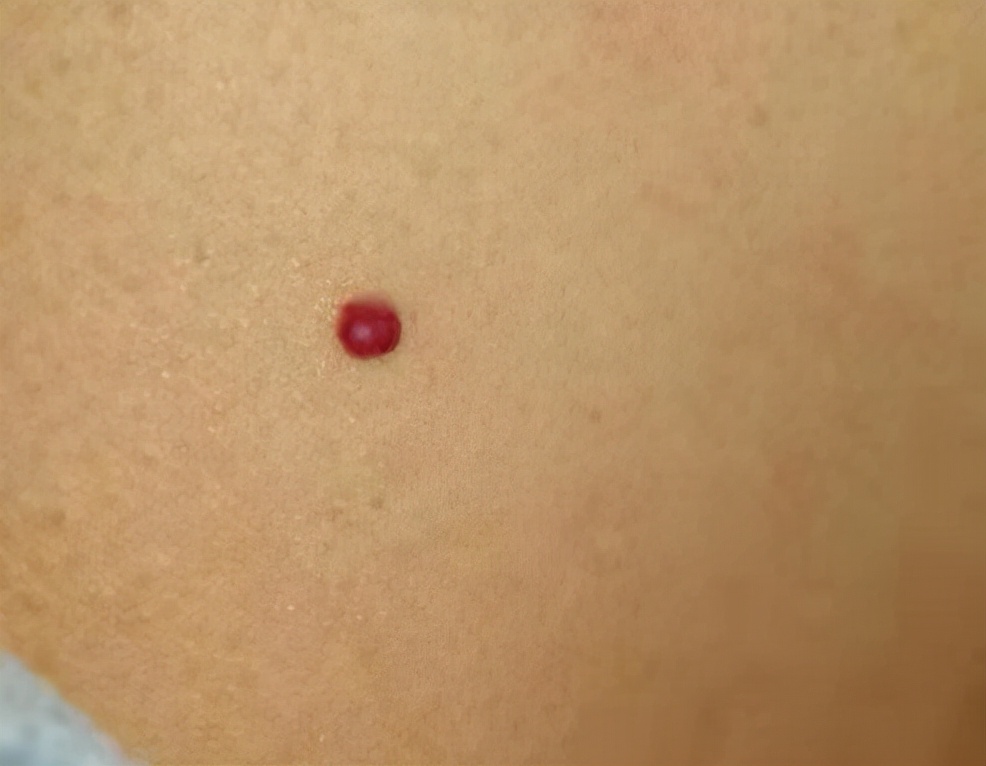 Is the red dot on the body a problem with the liver? - iNEWS