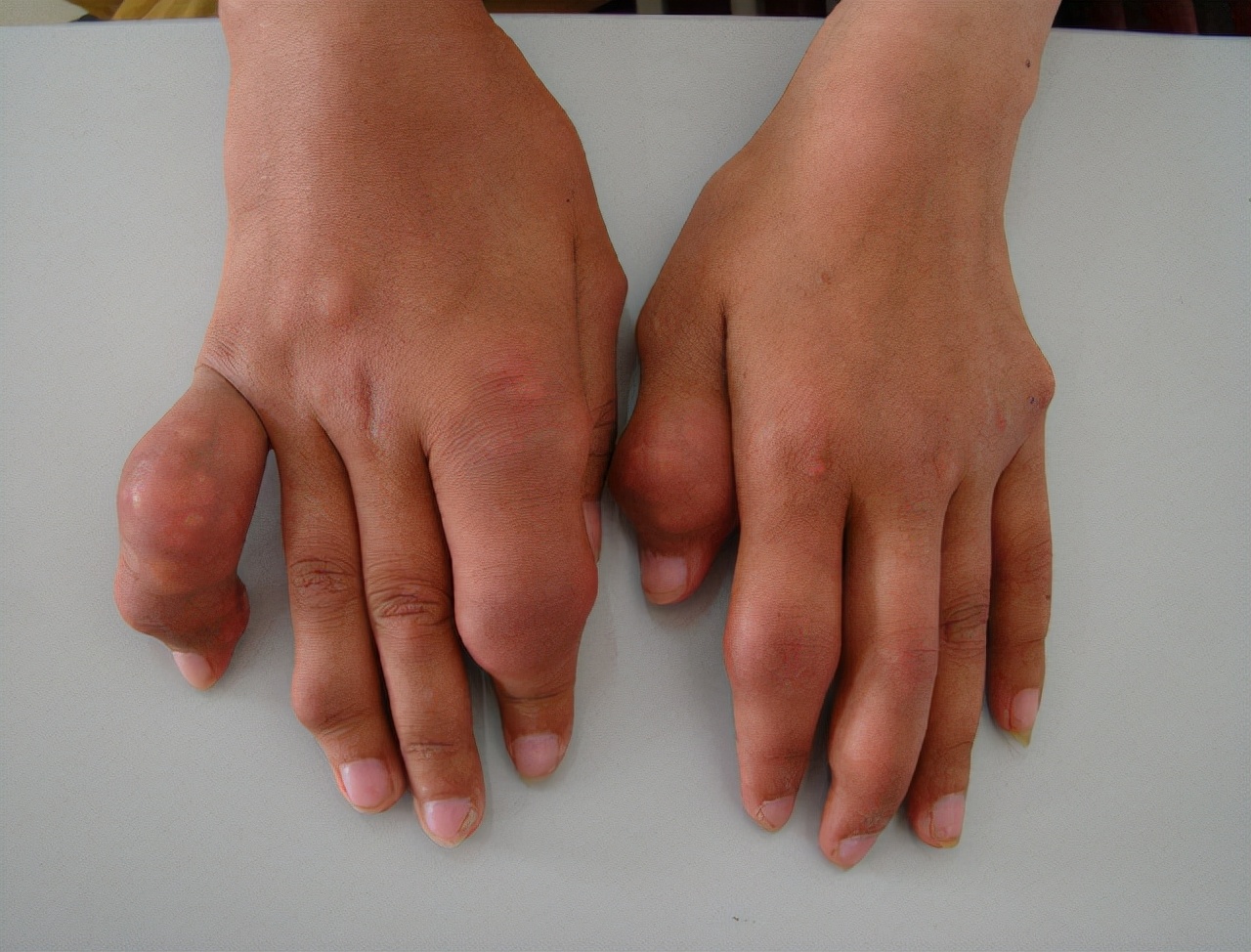 When uric acid is elevated, there may be 3 abnormalities in the hands ...