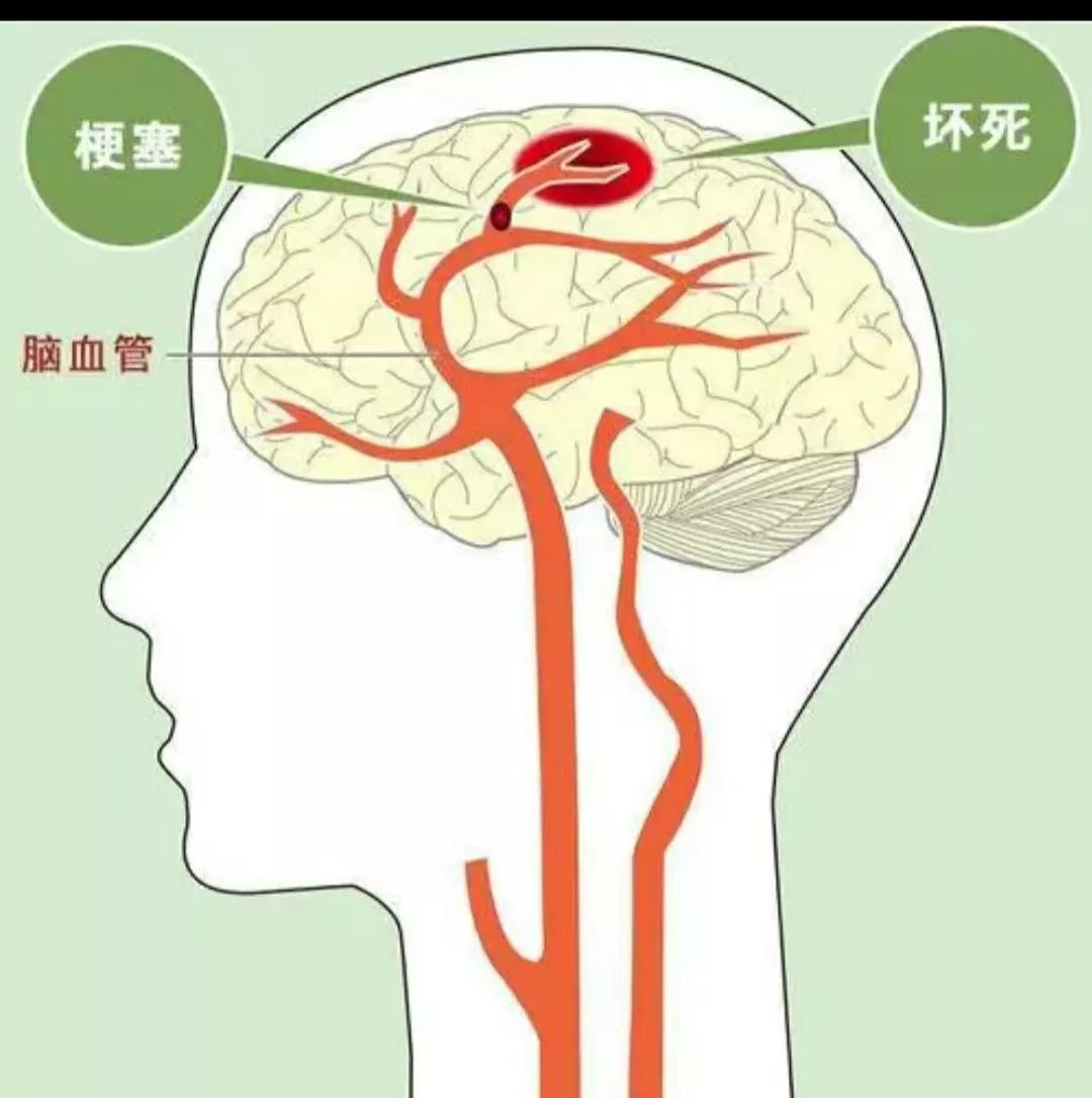 What are the early symptoms of cerebral infarction - iNEWS