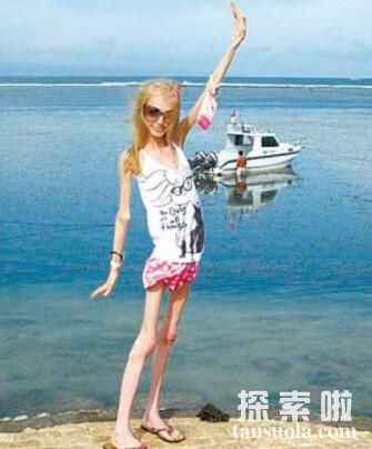 The thinnest person in the world: Kseniya Bubenko, excessive weight ...