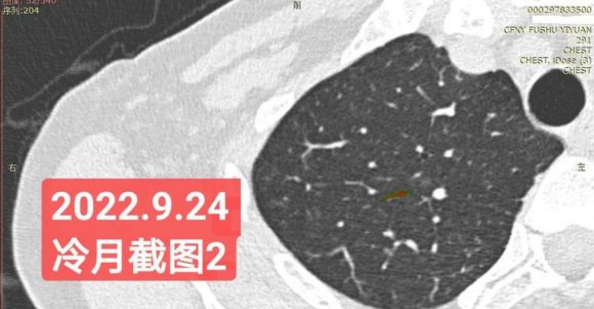 7mm high-risk pulmonary nodules cannot be cured and can only be treated ...