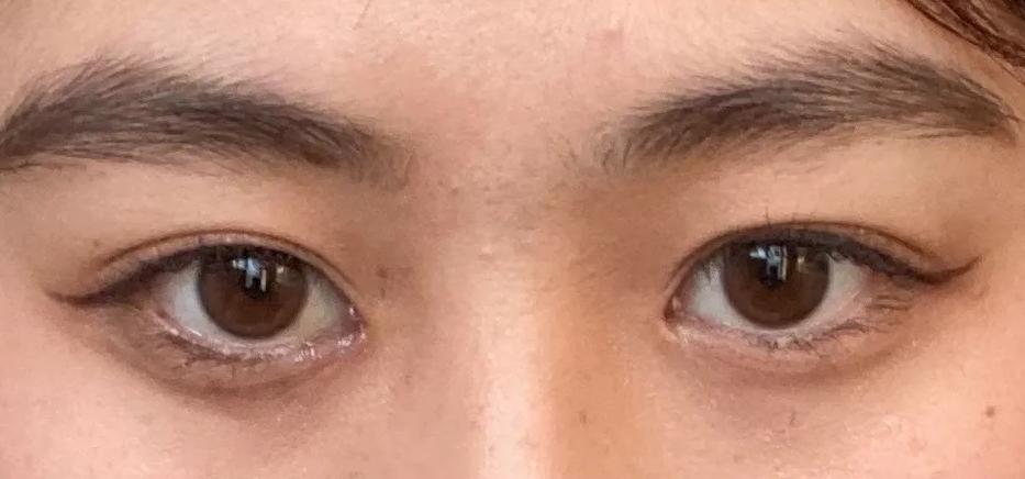 Can wearing prosthetic eyes improve short eyes? - iMedia