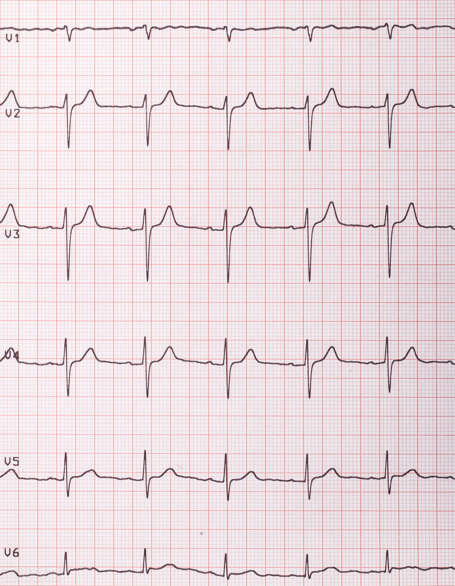 The explanation of normal electrocardiogram is worth seeing - iNEWS