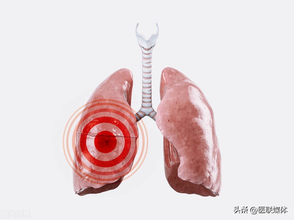 Phlegm is the "signal light" of lung disease. The four colors of phlegm ...