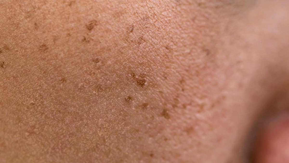 Why do older people develop age spots? It is recommended to do these 4 ...