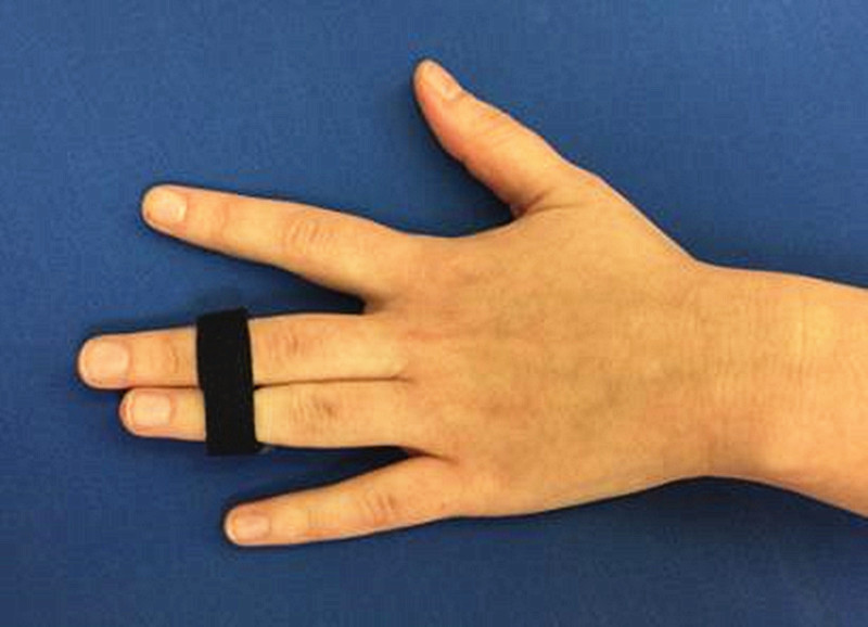 Sprained finger, no fracture, swollen and painful for 2 months, what's ...