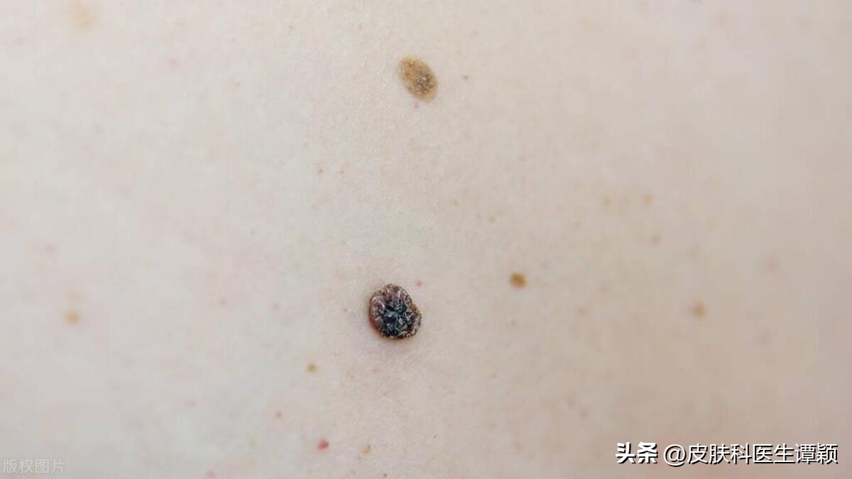 A dermatologist talks to you: What is a pigmented nevus? What ...