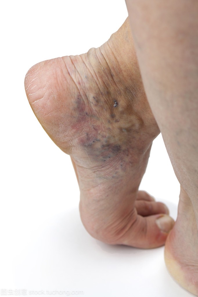 Detailed explanation of the six-level classification of varicose veins ...