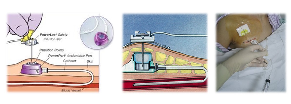 What is an infusion port?Why install an infusion port?How to care for ...