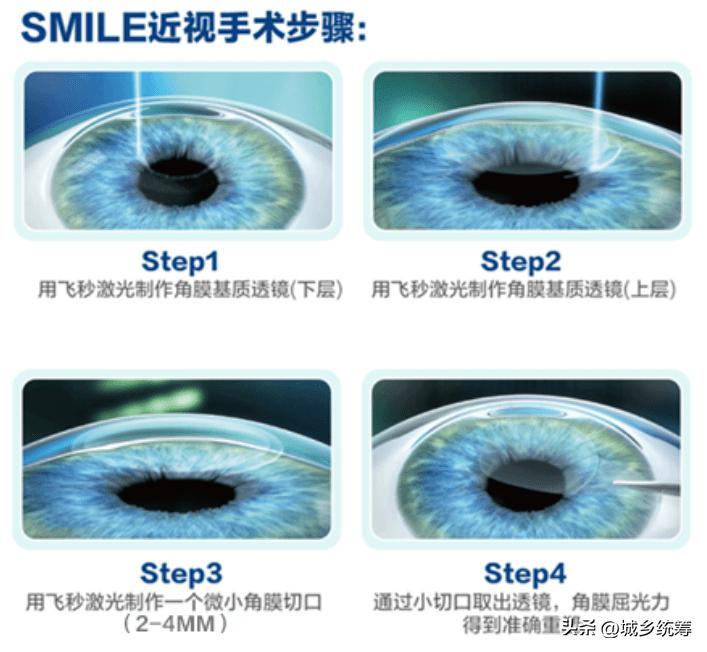 Laser myopia surgery - full femtosecond surgery - iNEWS