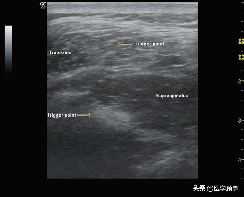 Can ultrasound become a "mirror mirror" for identifying myofascial ...