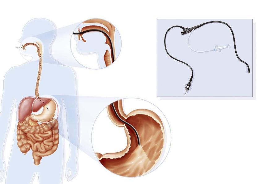 What is the difference between "ordinary gastroscopy" and "painless ...
