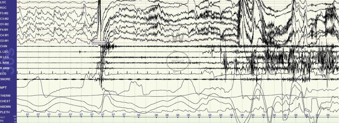 Abnormal nocturnal behavior in young adults: non-rapid eye movement ...