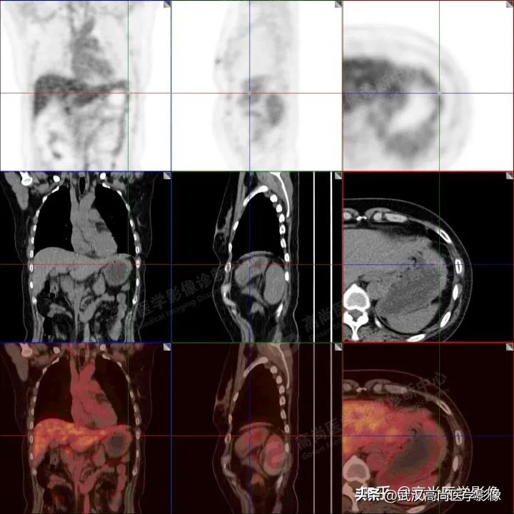 18F-FDG PET/CT manifestations and clinical value of gastric MALT ...