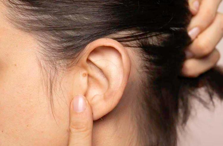 Where did the crease on the earlobe come from? Is it related to sudden ...