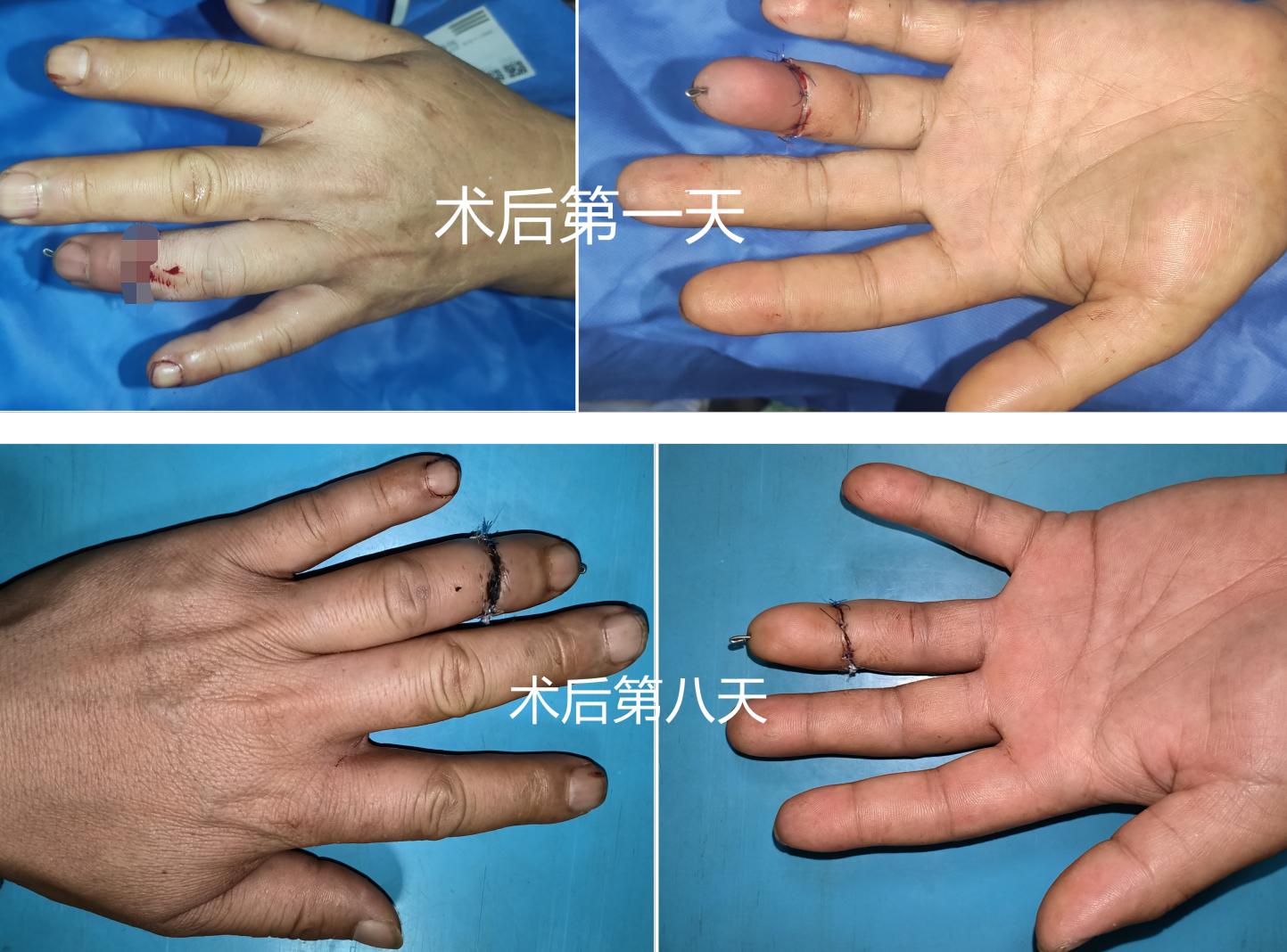 thrilling! The man's finger was cut off, and the doctor replanted the ...