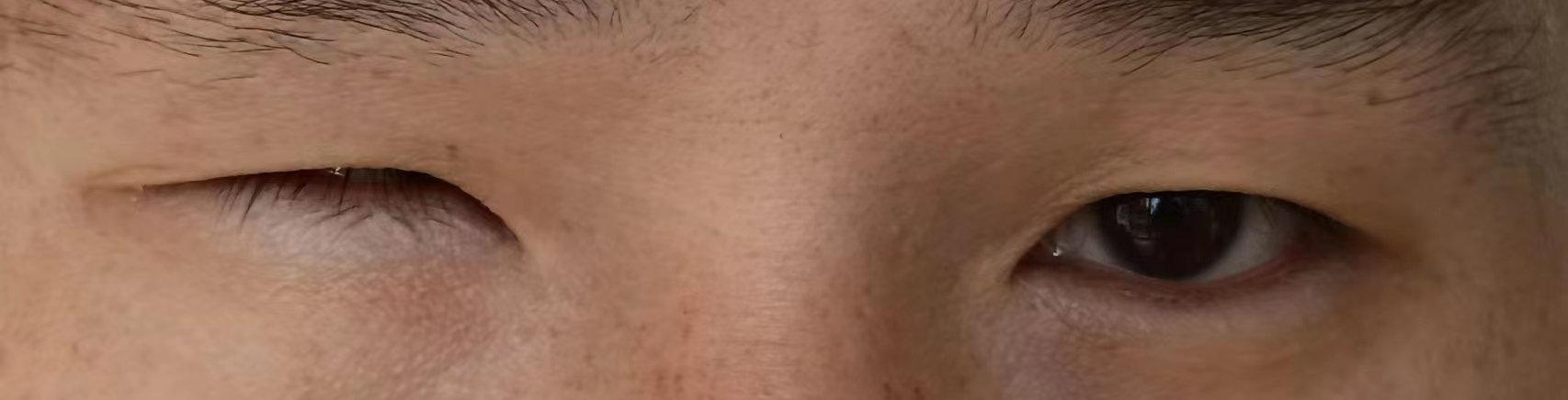 Congenital microphthalmia and poor eye condition, can I wear prosthetic ...